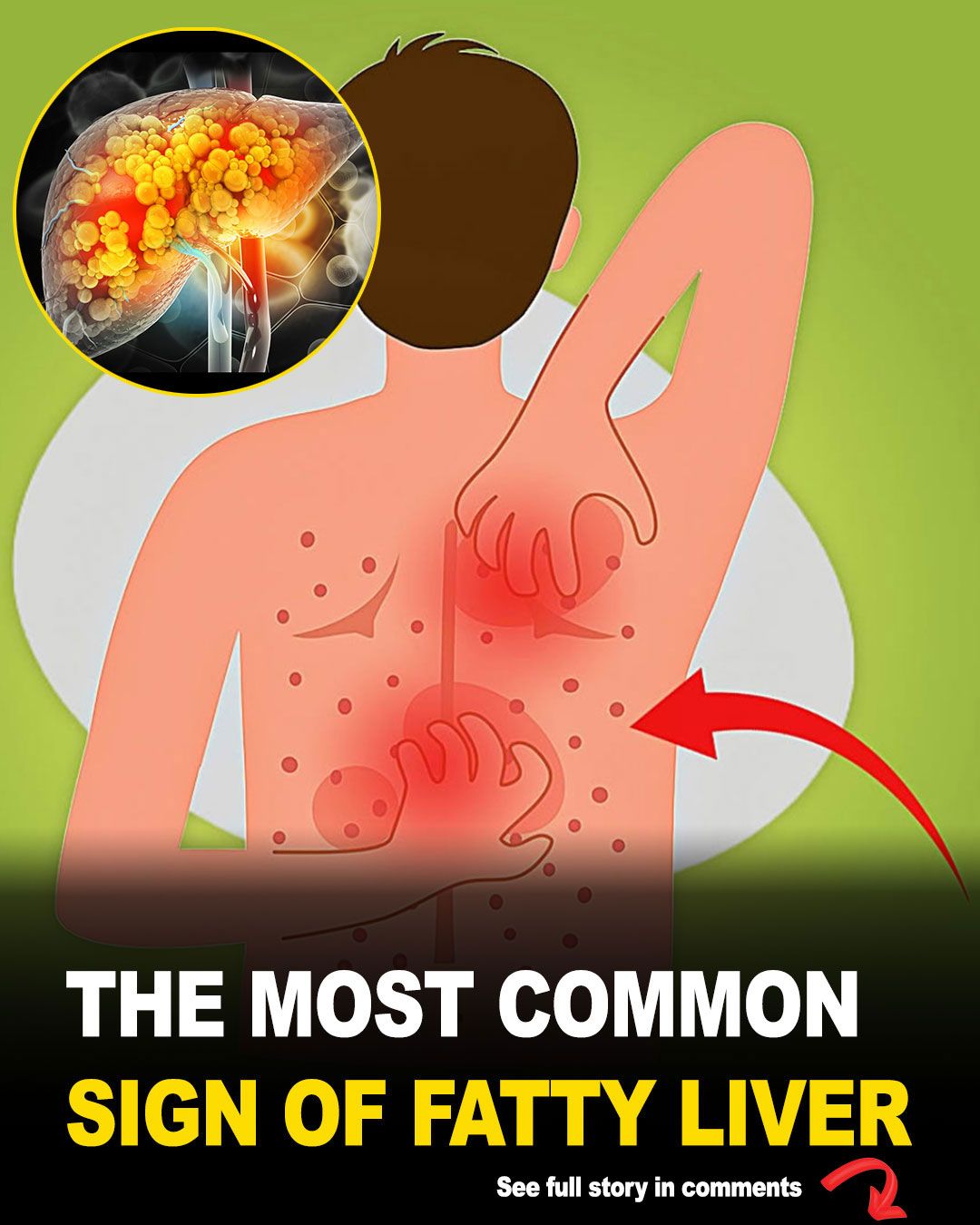 Fatty Liver Disease: What Causes It and What Are Its Symptoms - Amazing