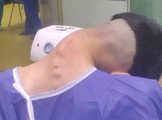 Man, 23, develops rare condition called 'dropped head syndrome' after ...
