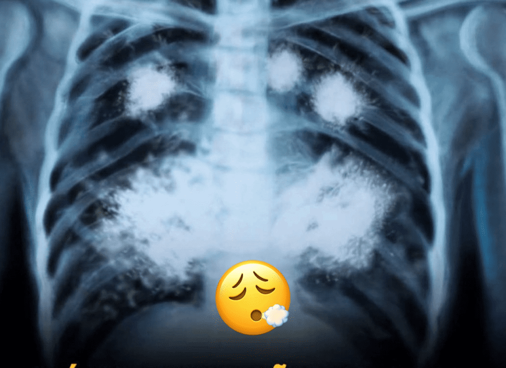 The Impact of Vape on the Health of a 20-Year-Old: A 60-Year-Old Lung ...